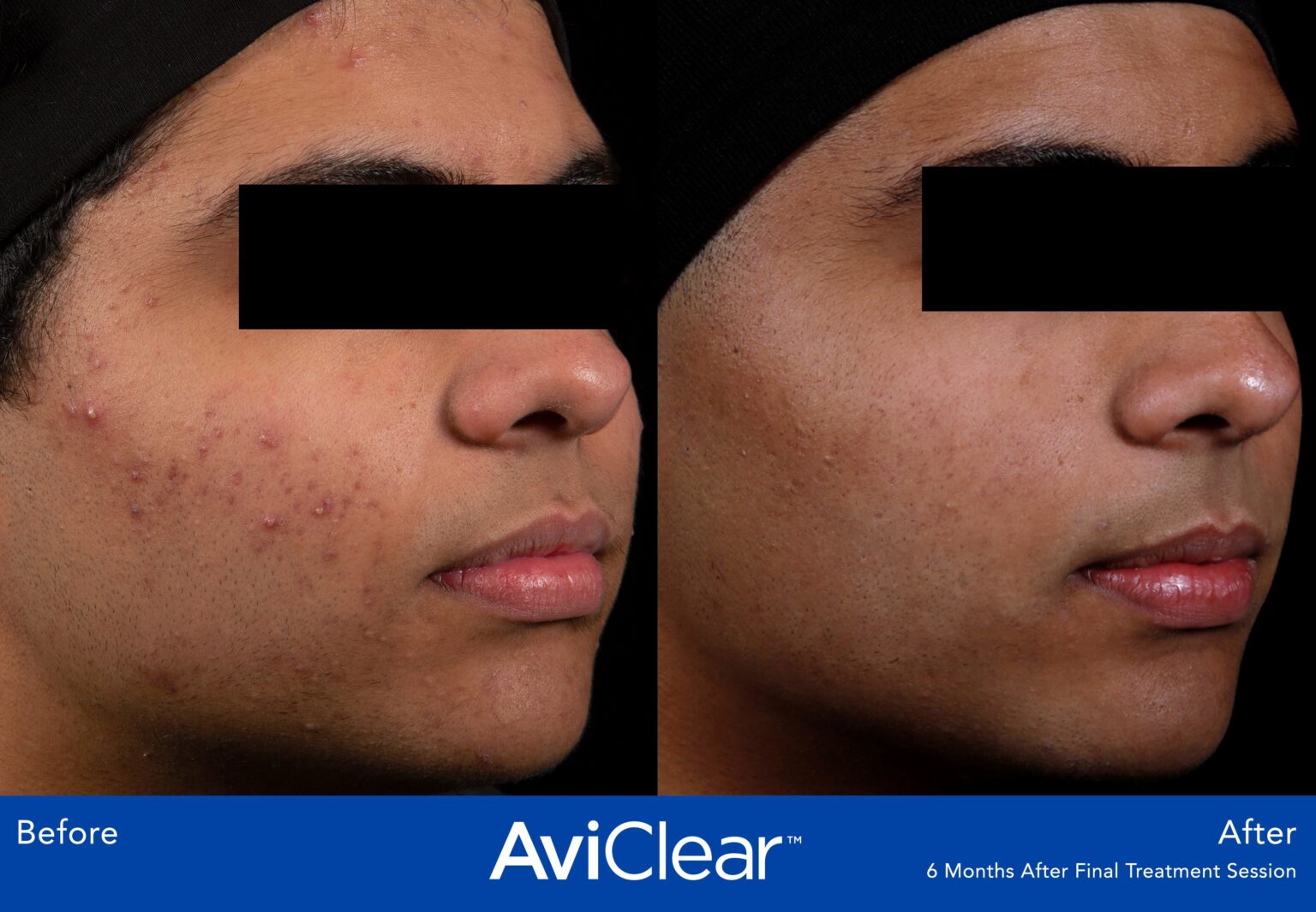 AviClear Acne Laser Treatment in Calgar | Beacon Dermatology