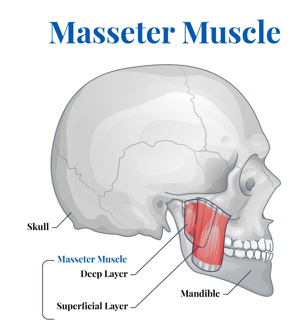 Masseter Muscle Botox Treats Bruxism and Offers Facial Slimming